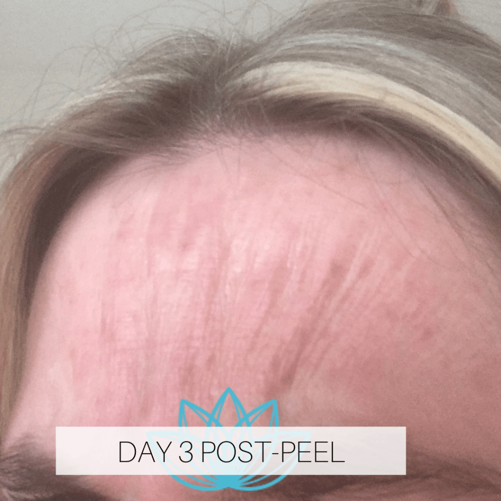 My Chemical Peel Journey | Review & Results | Pro Aesthetics