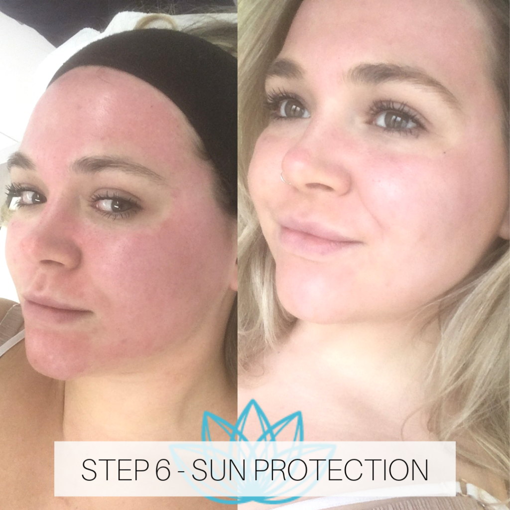 Microneedling Treatment Process | Pro Aesthetics Nottingham
